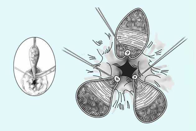 Phương pháp Milligan Morgan có ưu, nhược điểm gi? Quy trình thực hiện
