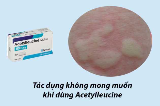 Acetyl leucine 500mg là thuốc gì? Cơ chế tác dụng, Chỉ định, Giá bán